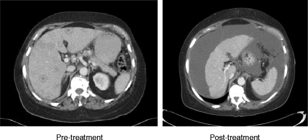 Causes of hepatic capsular retraction: a pictorial essay | SpringerLink