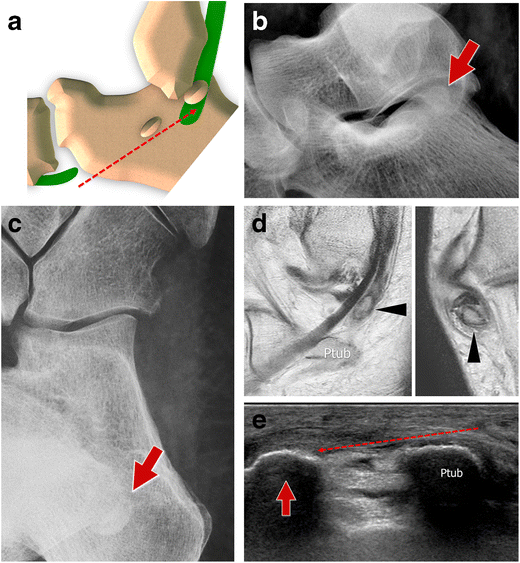 Os peroneum imaging: normal appearance and pathological findings ...