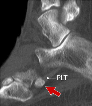 Os peroneum imaging: normal appearance and pathological findings ...