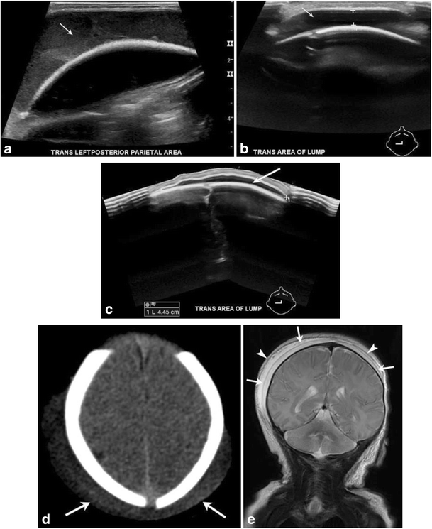 Mechanical birth-related trauma to the neonate: An imaging perspective ...