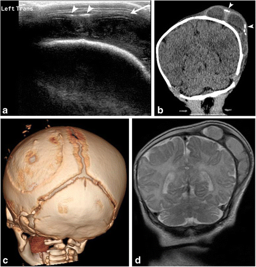 Mechanical birth-related trauma to the neonate: An imaging perspective ...