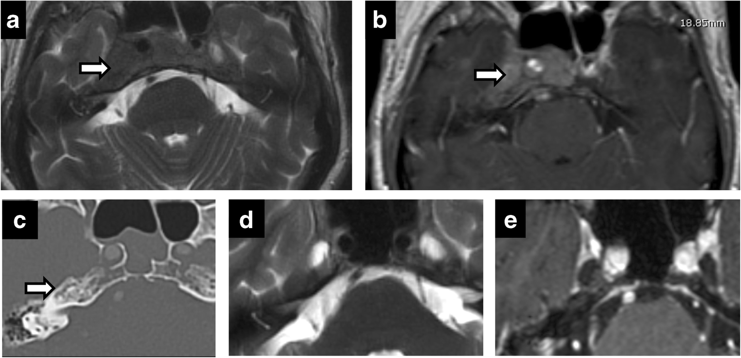 Neuroimaging of Meckel’s cave in normal and disease conditions ...