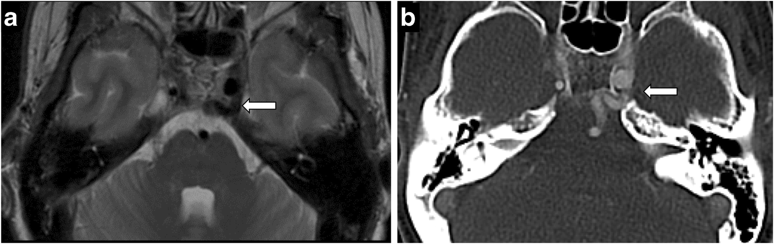 Neuroimaging of Meckel’s cave in normal and disease conditions ...