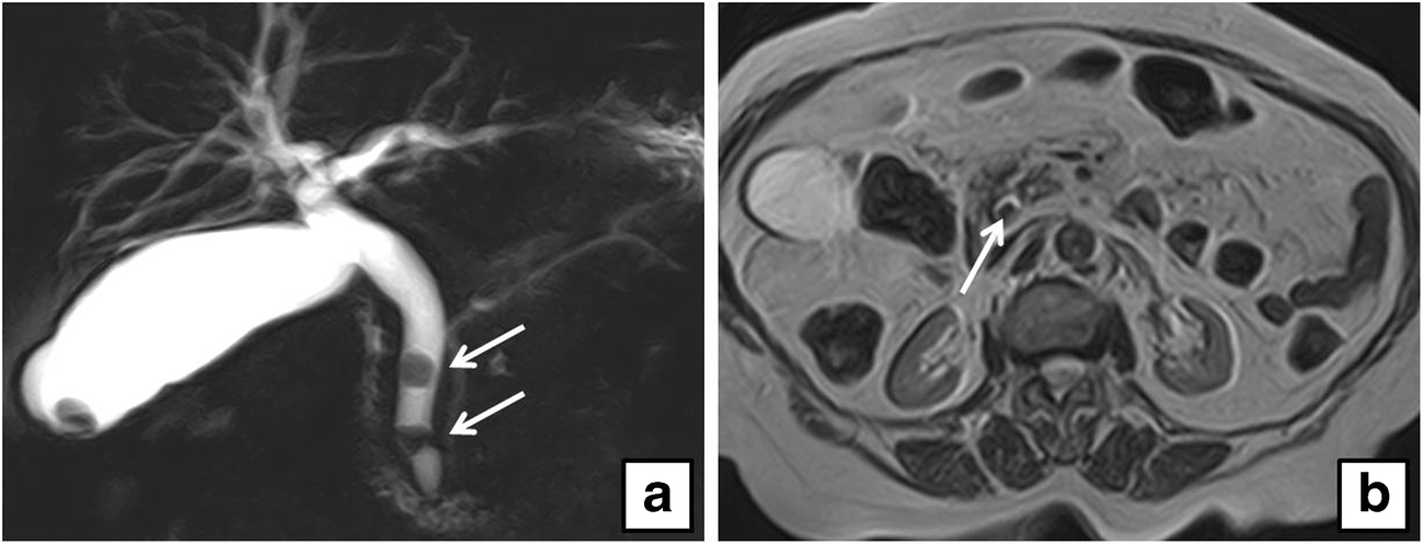 Routine MRCP in the management of patients with gallbladder stones awaiting cholecystectomy: a ...