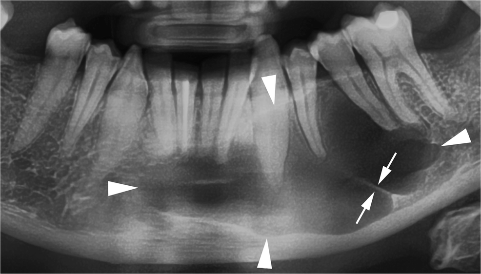 Odontogenic keratocyst: imaging features of a benign lesion with an ...