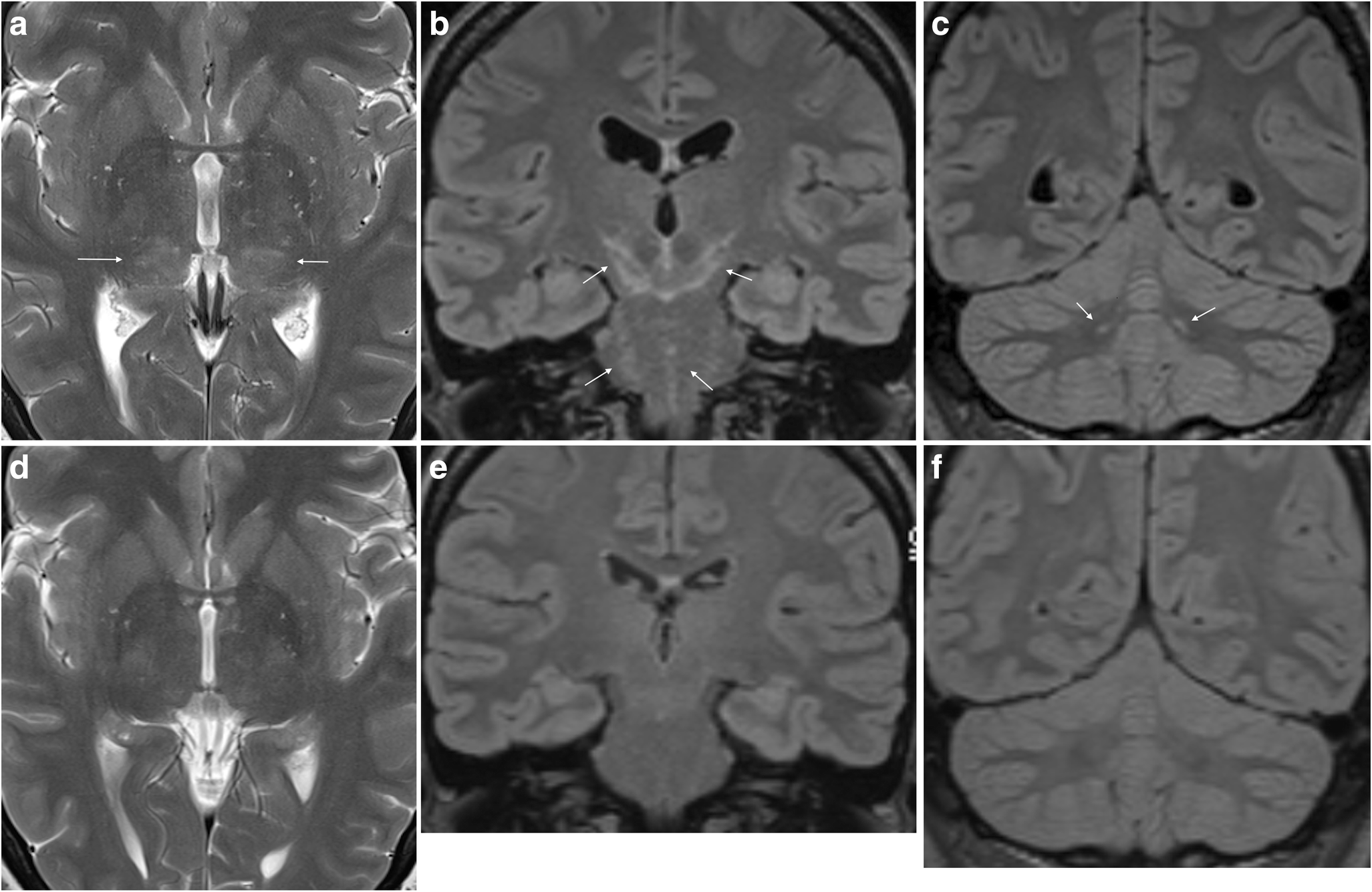 Imaging in Lyme neuroborreliosis | SpringerLink