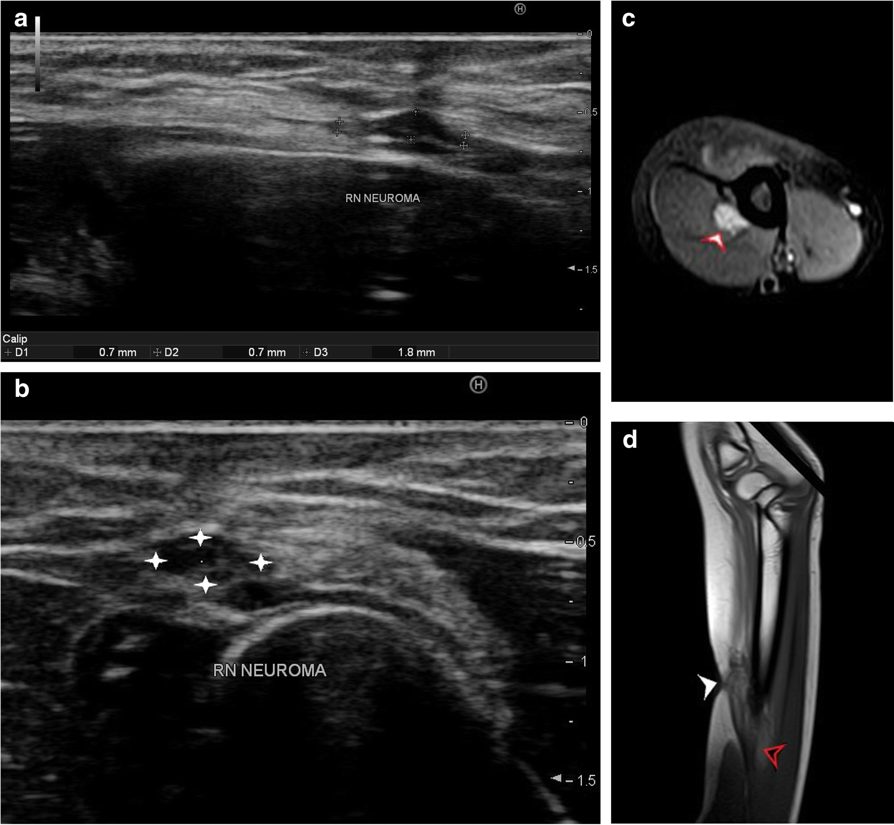 A panorama of radial nerve pathologies- an imaging diagnosis: a step ...