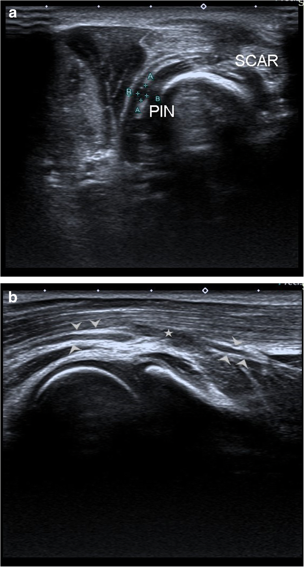 A panorama of radial nerve pathologies- an imaging diagnosis: a step ...