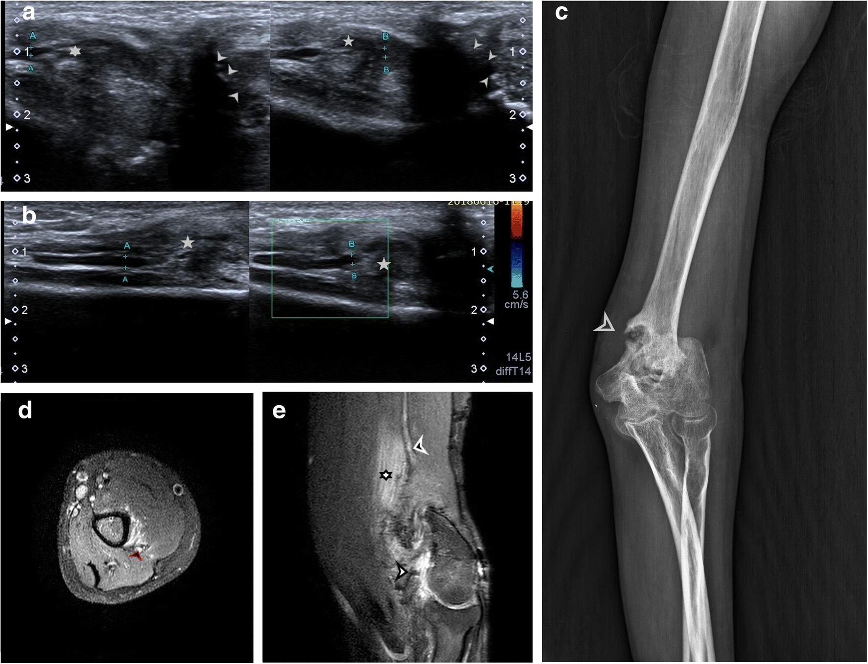 A panorama of radial nerve pathologies- an imaging diagnosis: a step ...