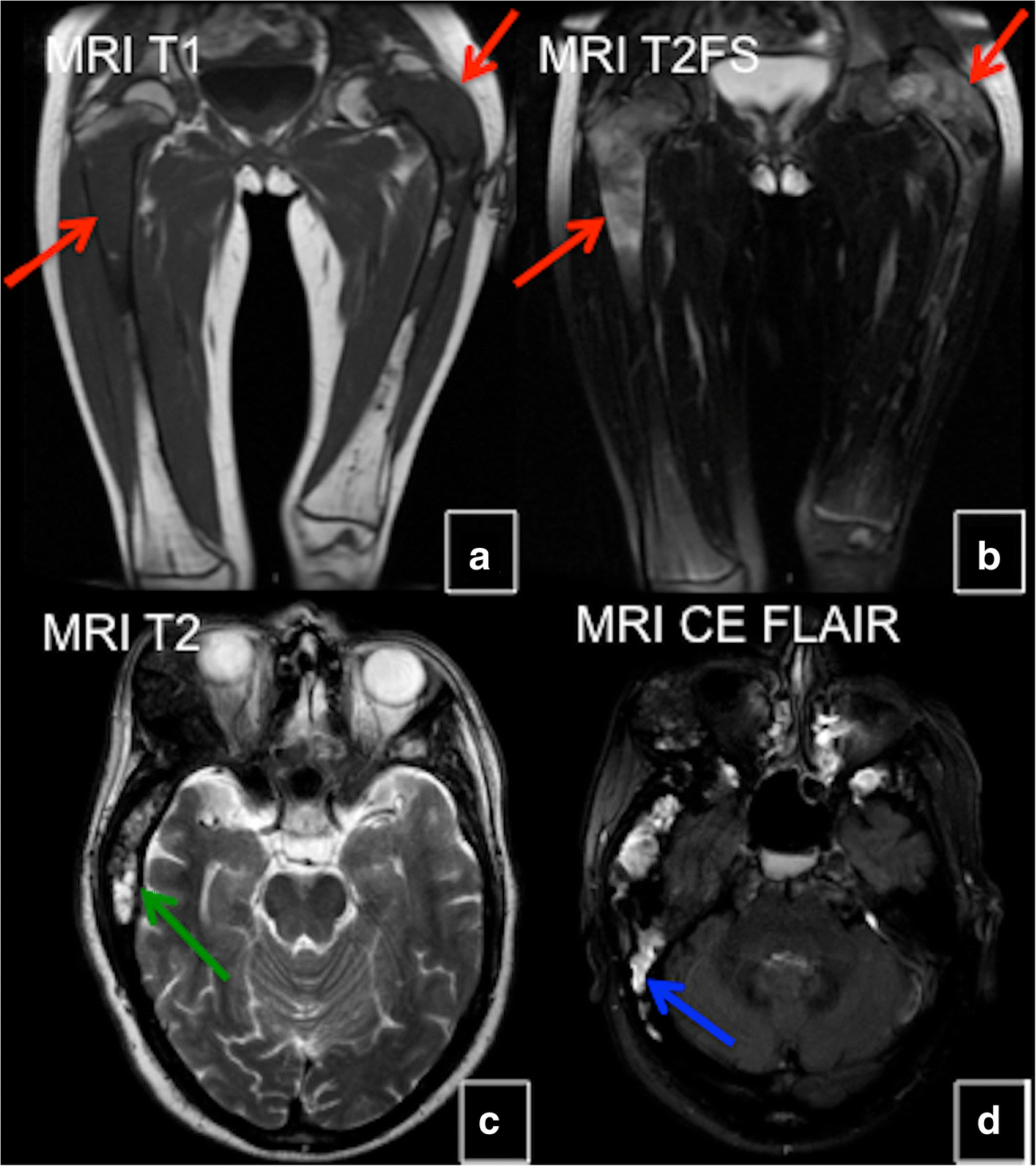 Fibrous dysplasia for radiologists: beyond ground glass bone matrix ...