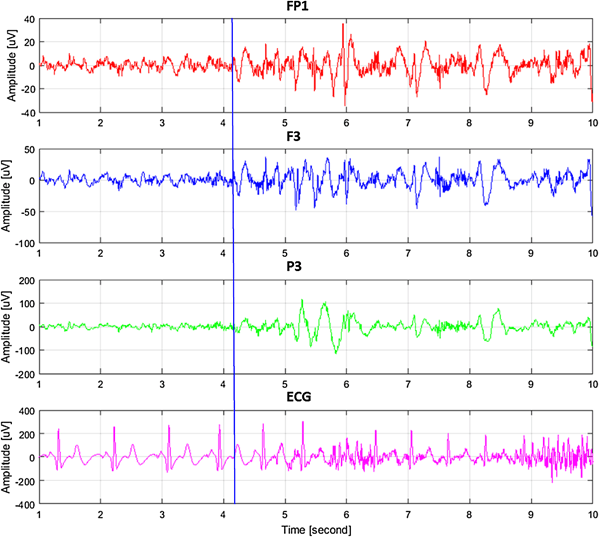 System for automatic heart rate calculation in epileptic seizures ...