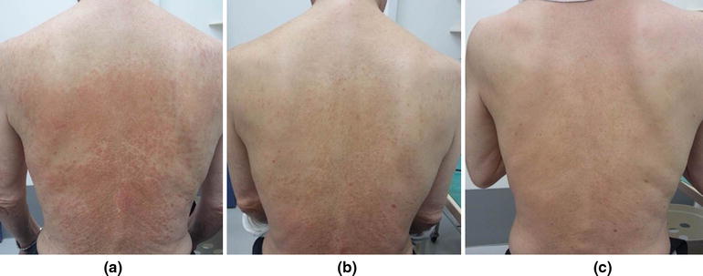 Drug-Induced Generalized Skin Eruption in a Diabetes Mellitus Patient ...