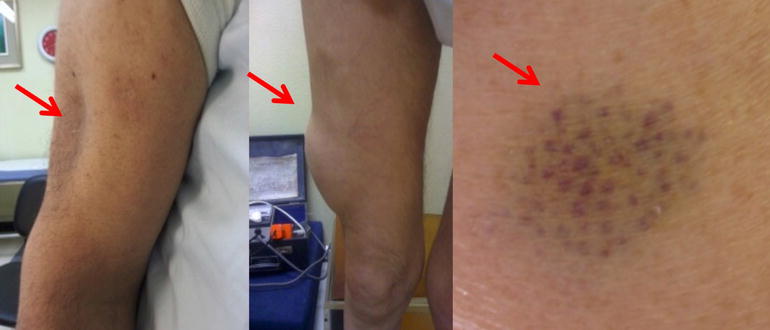 Lipodystrophy in Insulin-Treated Subjects and Other Injection-Site Skin ...