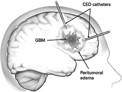 Convection-Enhanced Delivery | SpringerLink