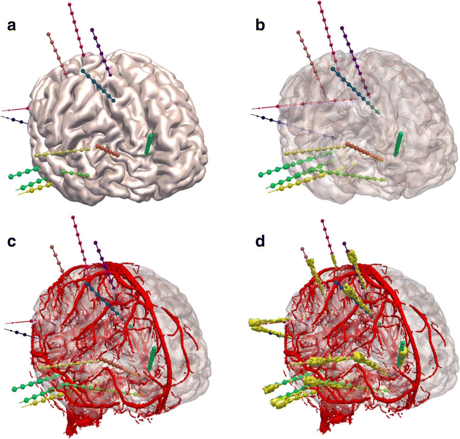 Computer-Assisted Planning for Stereoelectroencephalography (SEEG ...