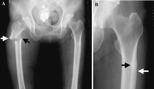 Weekly Teriparatide for Delayed Unions of Atypical Subtrochanteric ...