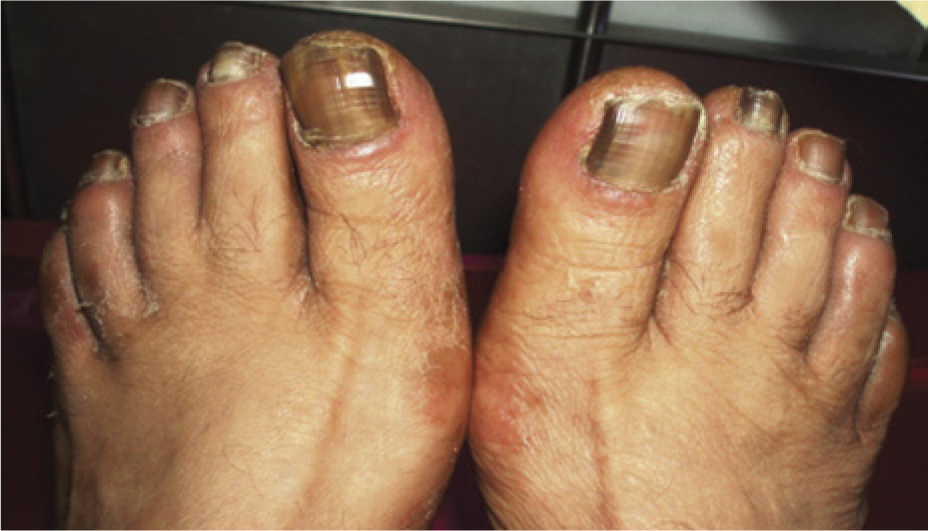 Erosive lichen planus of the soles: Effective response to prednisone ...