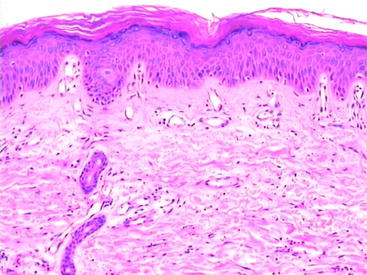 Autoerythrocyte Sensitization Syndrome Presenting with General ...