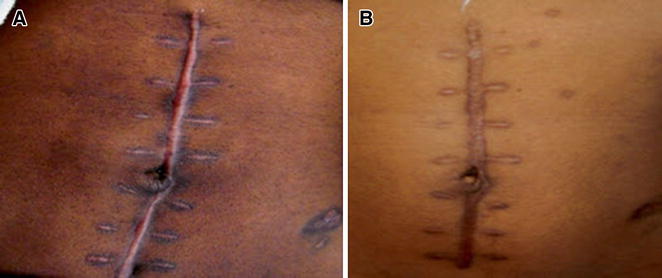 Efficacy and Safety of an Advanced Formula Silicone Gel for Prevention ...