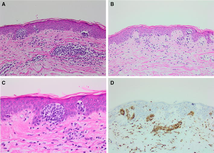 Invisible Mycosis Fungoides: Not to be Missed in Chronic Pruritus ...