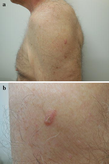 Injection Site Lichenoid Dermatitis Following Pneumococcal Vaccination ...