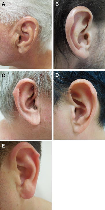 Darwin’s Tubercle: Review of a Unique Congenital Anomaly | SpringerLink
