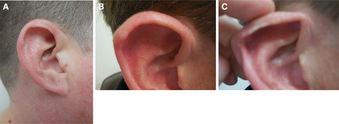 Darwin’s Tubercle: Review of a Unique Congenital Anomaly | SpringerLink