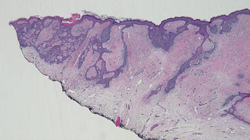 Fibroepithelioma of Pinkus Revisited | SpringerLink