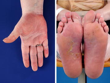 Psoriasiform Eruption and Worsening of Pustulosis Palmoplantaris After ...