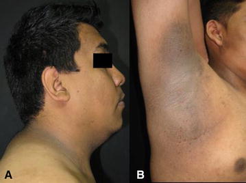 Skin Manifestations of Insulin Resistance: From a Biochemical Stance to ...