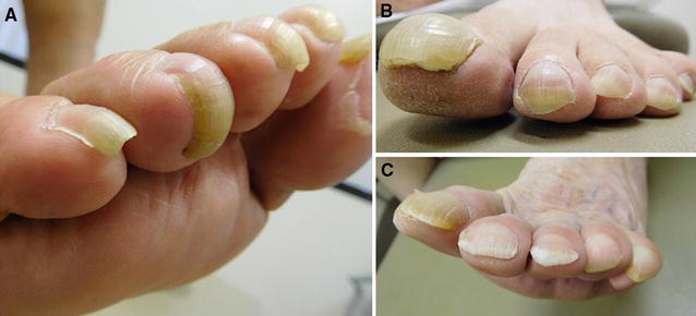 Parrot Beak Nails Revisited: Case Series and Comprehensive Review ...