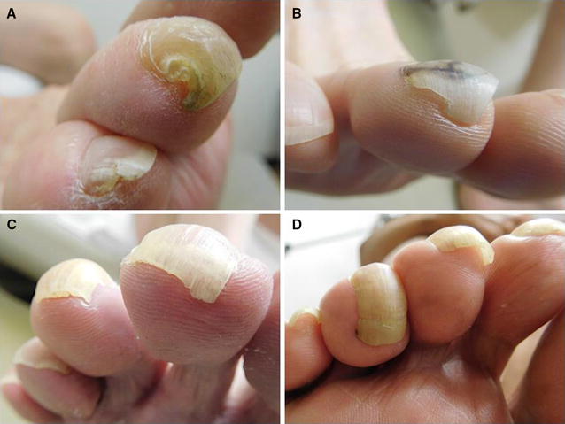 Parrot Beak Nails Revisited: Case Series and Comprehensive Review ...