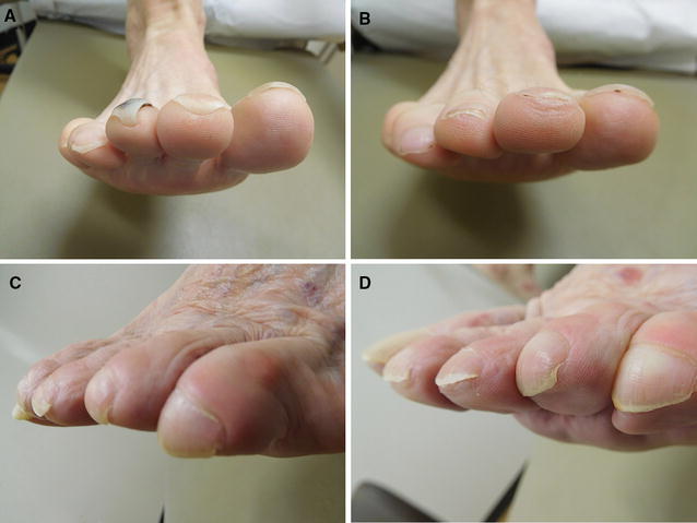 Parrot Beak Nails Revisited: Case Series and Comprehensive Review ...