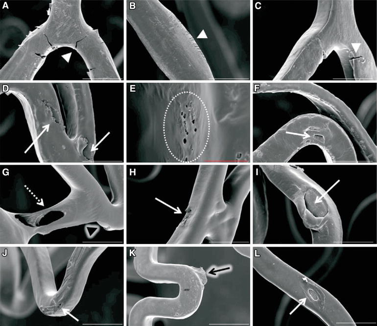 Evolution of Coronary Stents: From Bare-Metal Stents to Fully ...