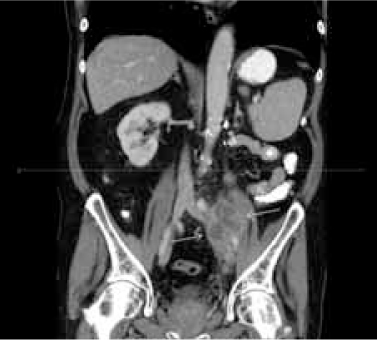 Urotheelcelcarcinoom van de ureterstomp na nefrectomie wegens ...