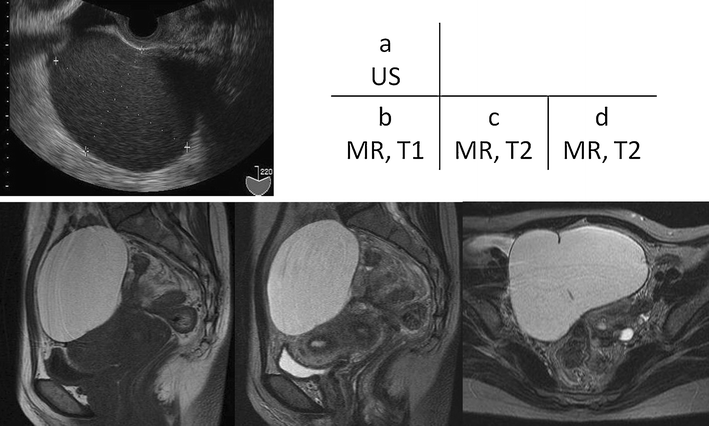 Clinical Management of Ovarian Endometriotic Cyst (Chocolate Cyst ...