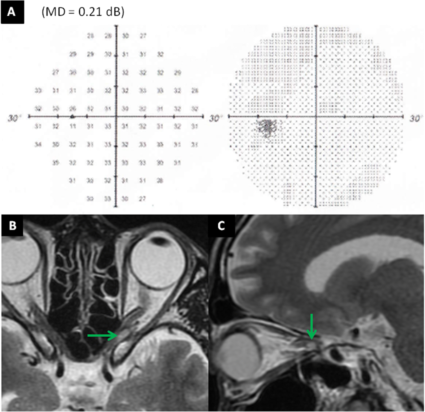 The rapid improvement in visual field defect observed with weekly ...