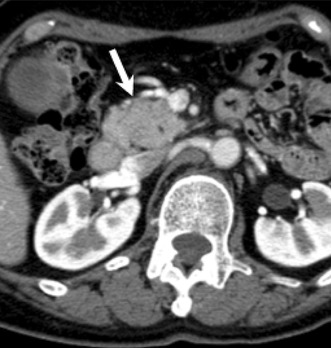 A case of IgG4-related kidney disease with predominantly unilateral ...