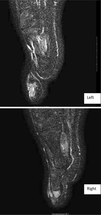 Osteomyelitis of bilateral great toes: iatrogenic complication of nerve ...