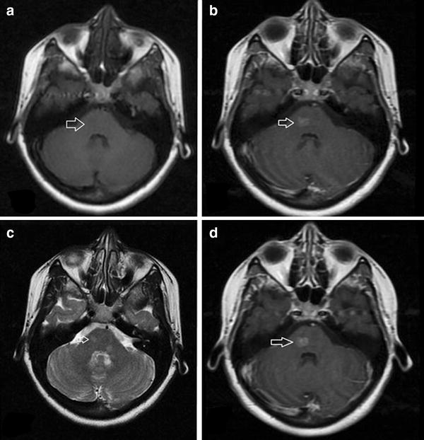 Capillary telangiectasia mimicking an active demyelinating lesion in a ...
