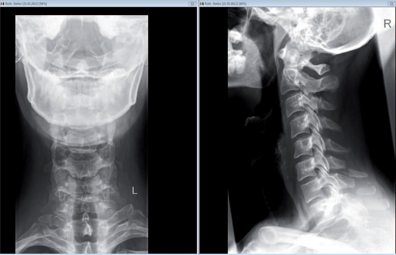 Seit dem Golfspiel schmerzt die Halswirbelsäule | SpringerLink
