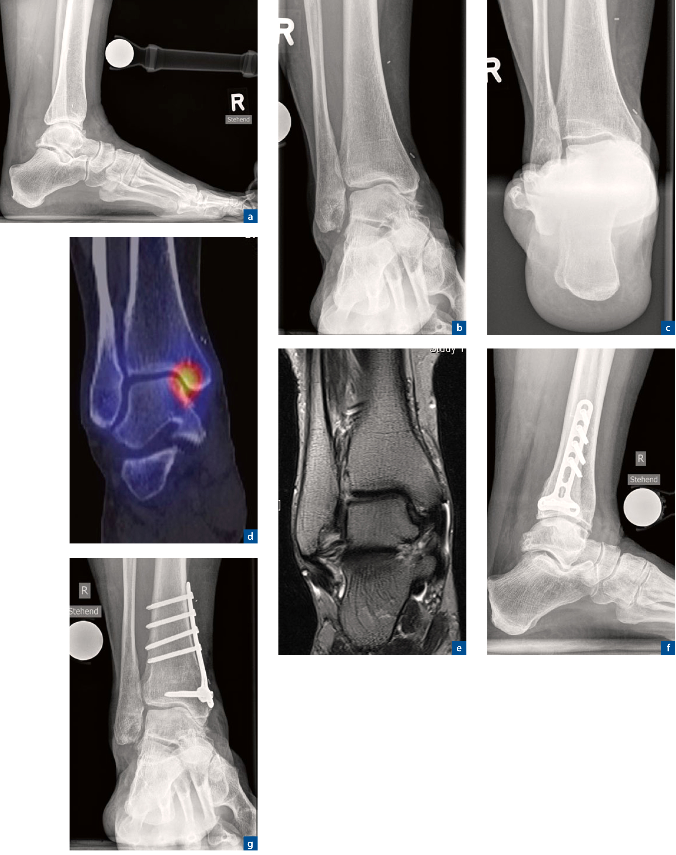 Management der Sprunggelenksarthrose | SpringerLink