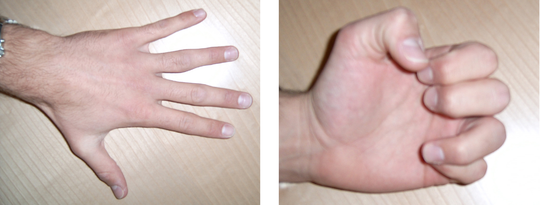 Korrekturosteotomien an Hand und Handgelenk | SpringerLink