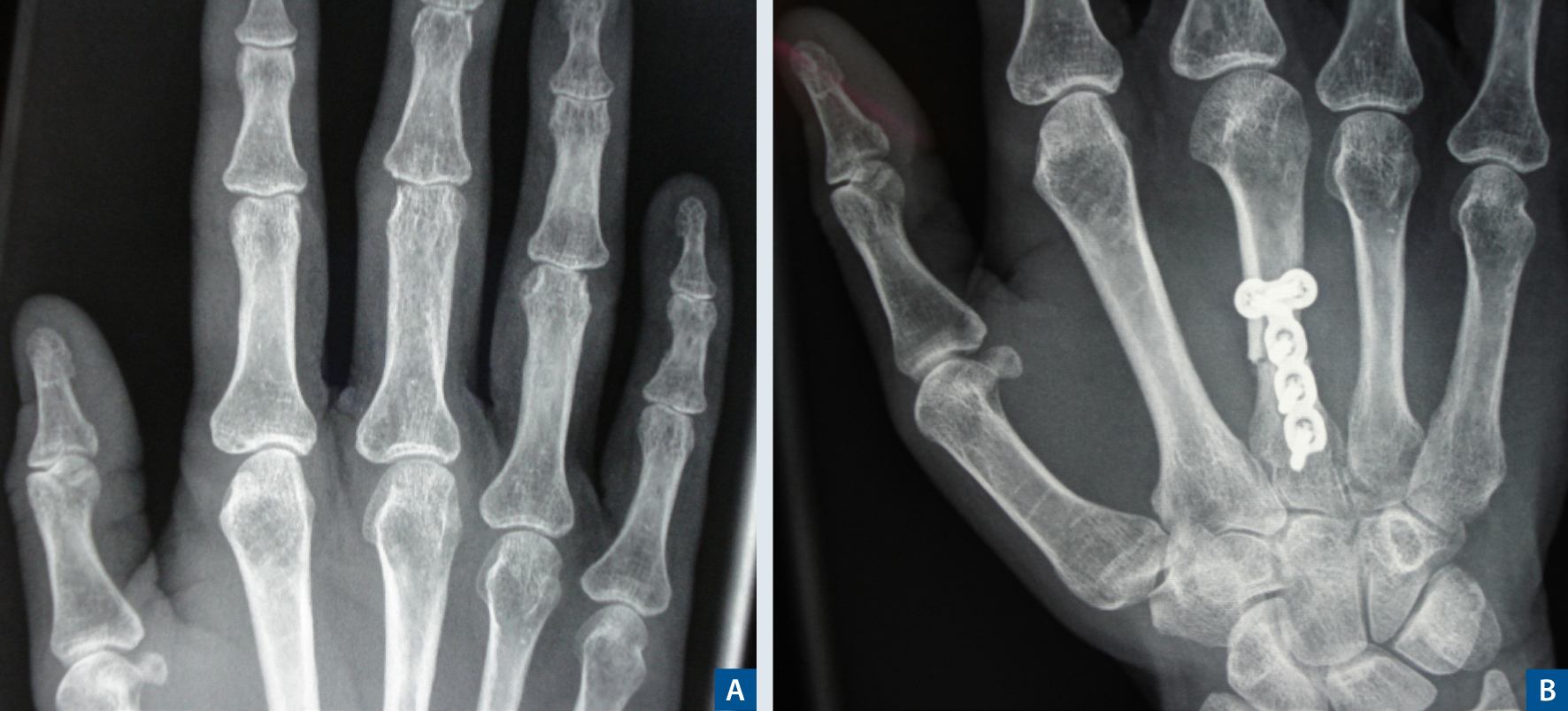 Korrekturosteotomien an Hand und Handgelenk | SpringerLink