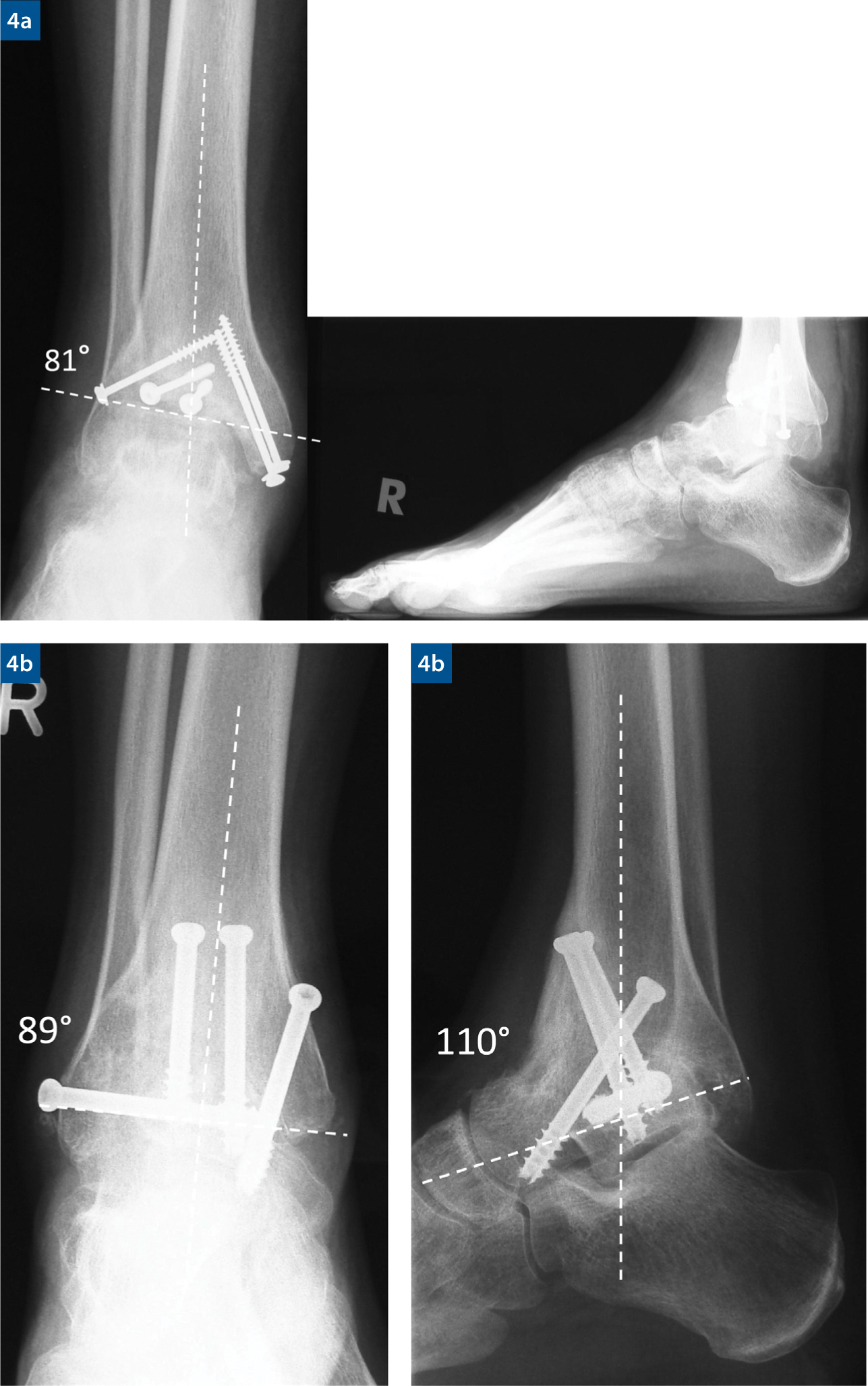 Die Therapie der fortgeschrittenen Arthrose des oberen Sprunggelenks ...