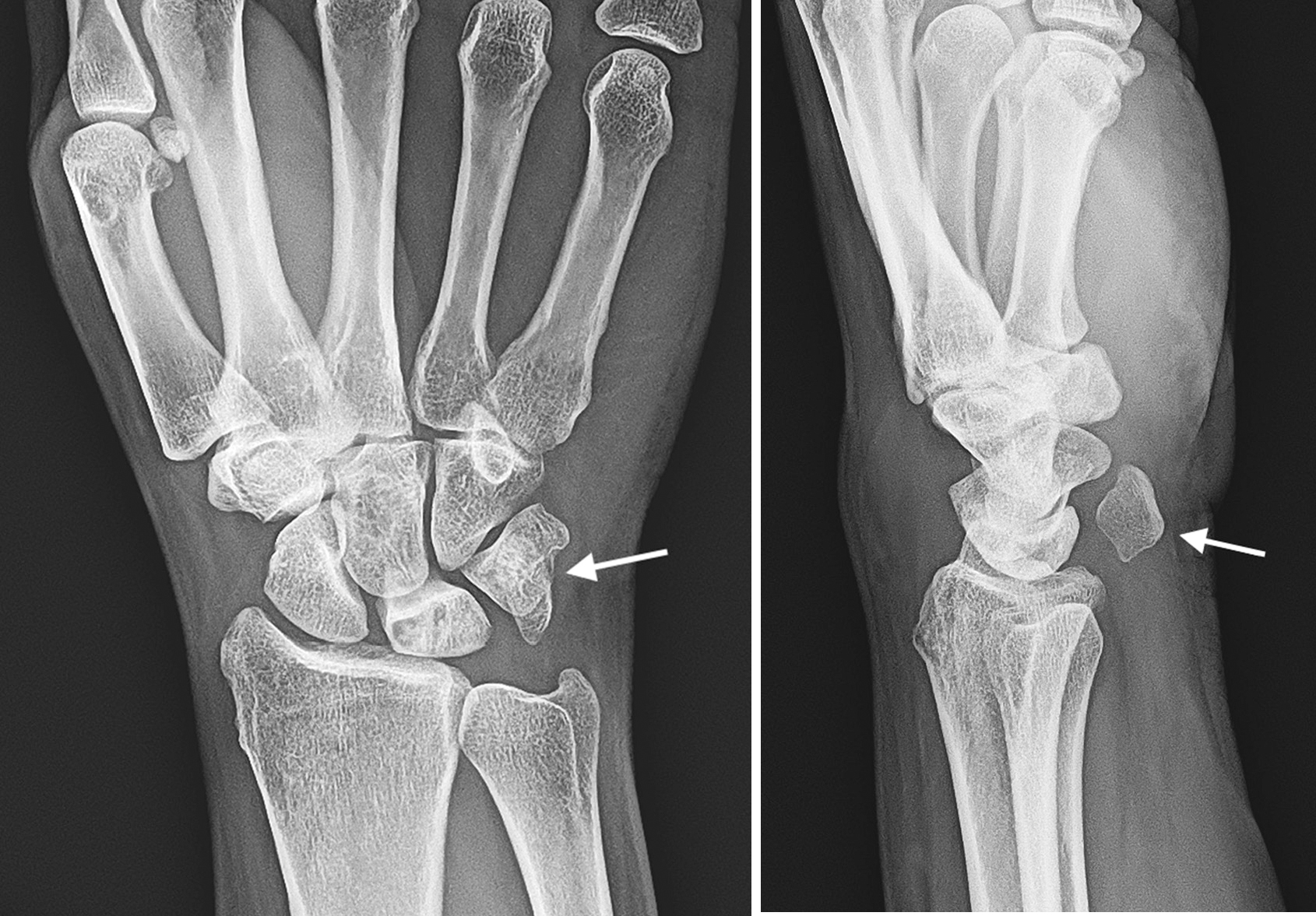 Seltene Dislokation nach einem Sturz | SpringerLink