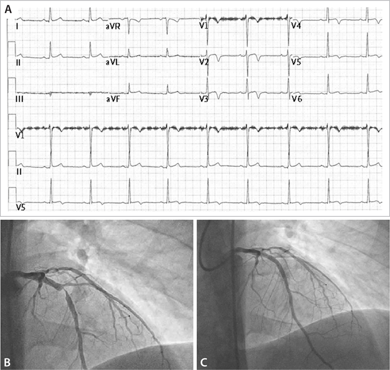 EKG-Ableitung weist den Weg zur Diagnose eines Wellens-Syndroms | SpringerLink