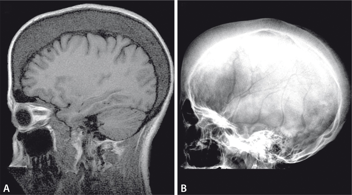 Bildgebung enthüllt Bürstenschädel | SpringerLink