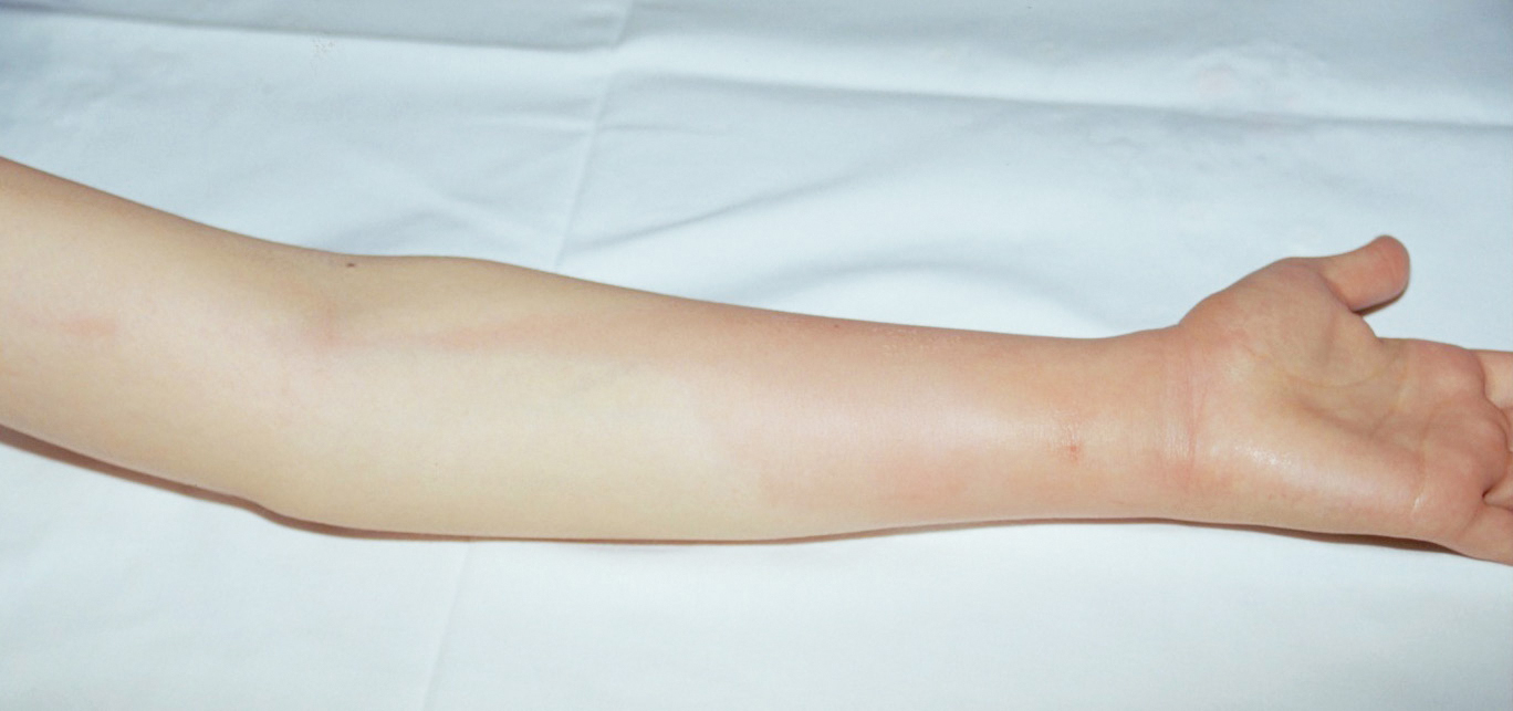 Akute Lymphangitis | SpringerLink