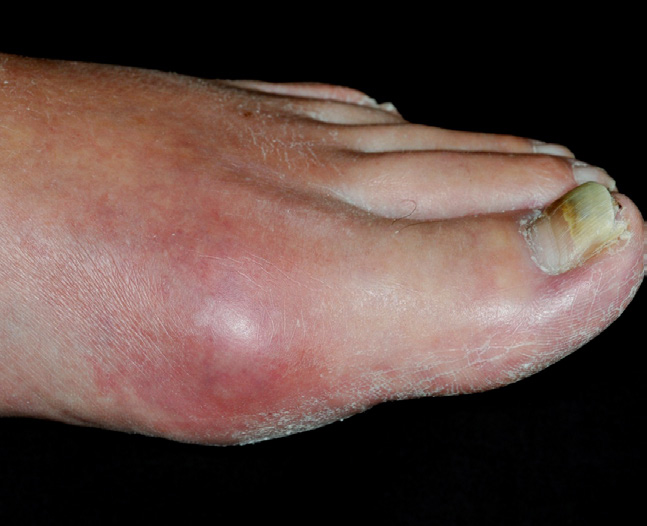 Akuter Gichtanfall | SpringerLink